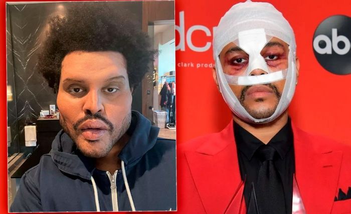 Saiba o significado das mudanças polêmicas no rosto de The Weeknd